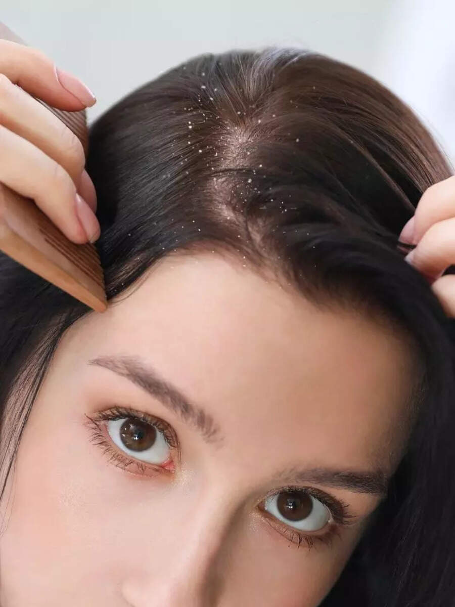Why Dandruff Occurs what is the science behind it | Times Now Navbharat