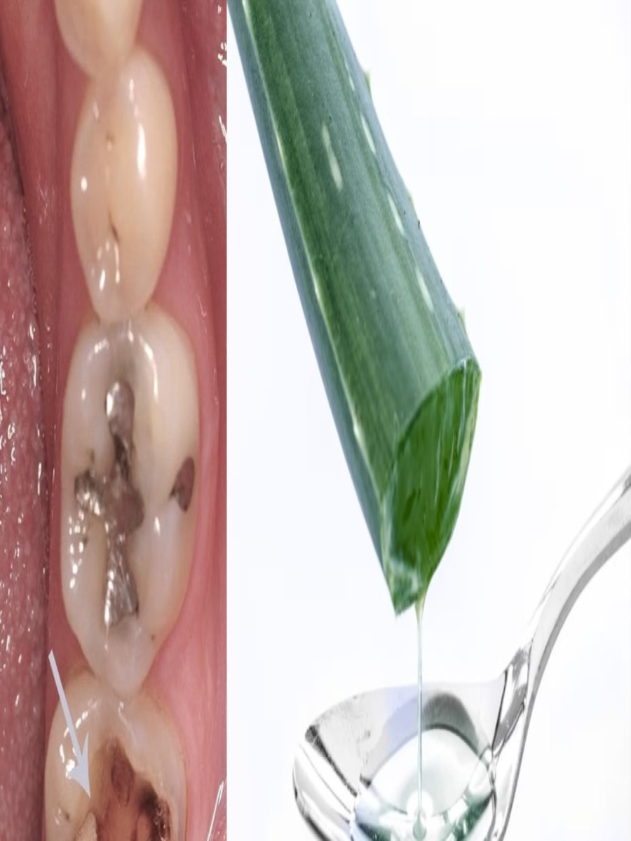 worms in the teeth removal tips cavity home remedies know how to use ...